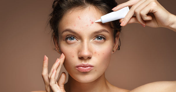 How Long Does It Take to Get Rid of Acne? Understanding Timelines and ...