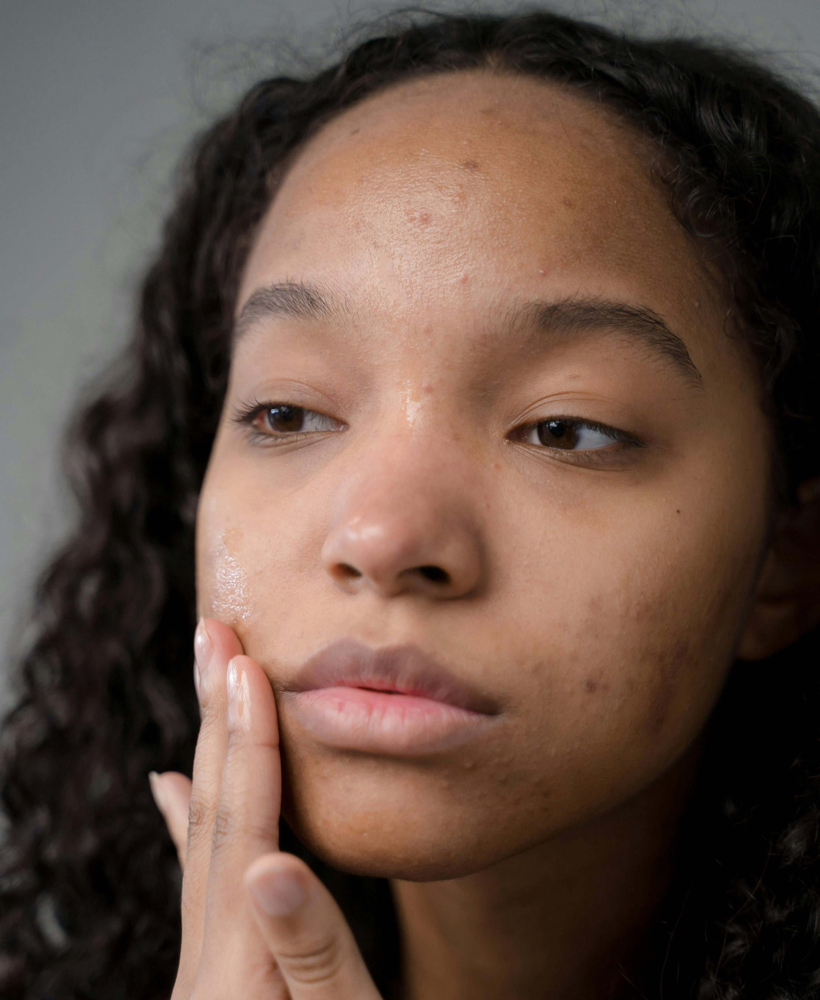 How Long Does It Take to Get Rid of Acne? Understanding Timelines and ...